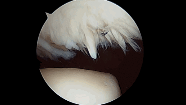 chondromalacia patella GIF - Larson Sports and Orthopaedics